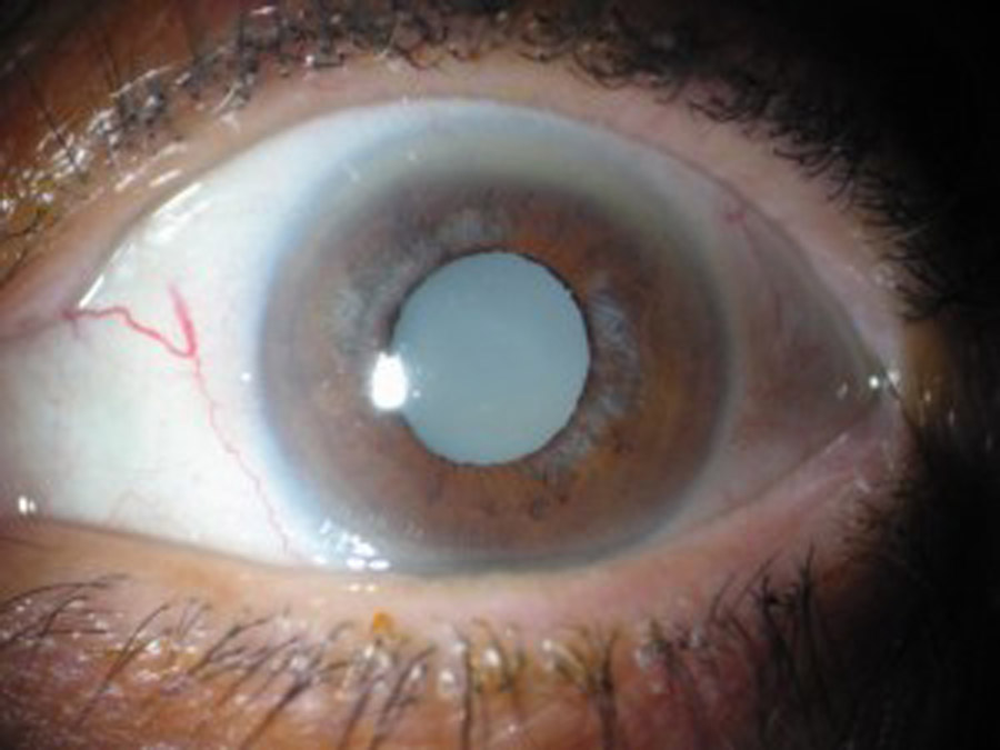 दाङमा साढे पाँच हजार मोतिविन्दुका बिरामी « Dainiki